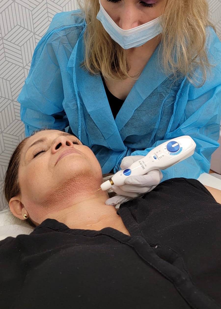 Reducción de flacidez en Papada con fibroblast – Smart Skincare